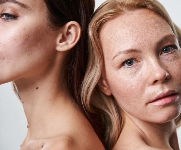 Best CO2 Active-Deep Fx Treatment Dublin | Laser + Skin Clinics