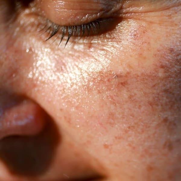 Best Age Spots Treatment Dublin | Laser + Skin Clinics