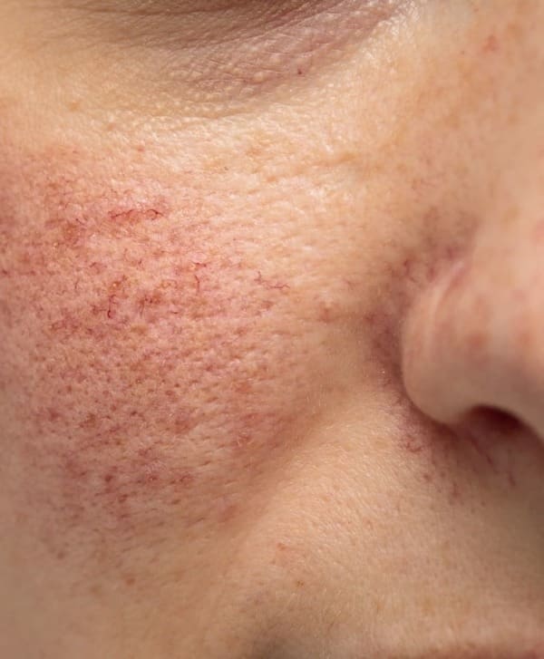 Best Blush Redness Dublin | Laser + Skin Clinics