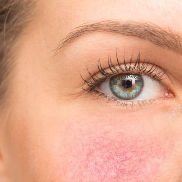 Best Blush Redness Dublin | Laser + Skin Clinics