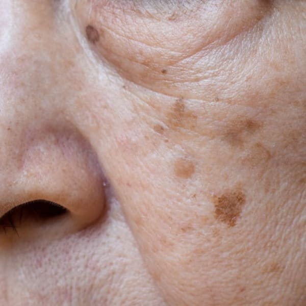Best Lentigines Treatment Dublin | Laser + Skin Clinicsn