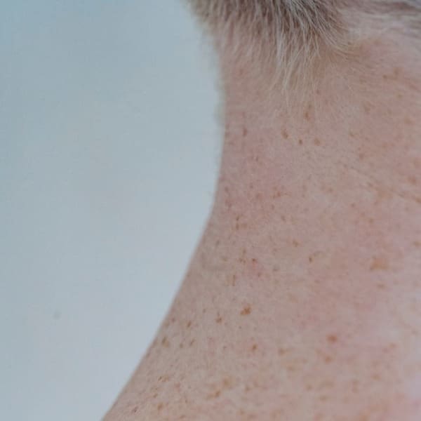 Best Sciton BBL Dublin | Laser + Skin Clinics | Dublin IPL