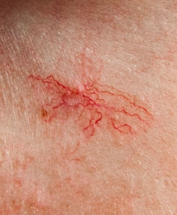 Best Spider Naevi Treatments Dublin | Laser + Skin Clinics