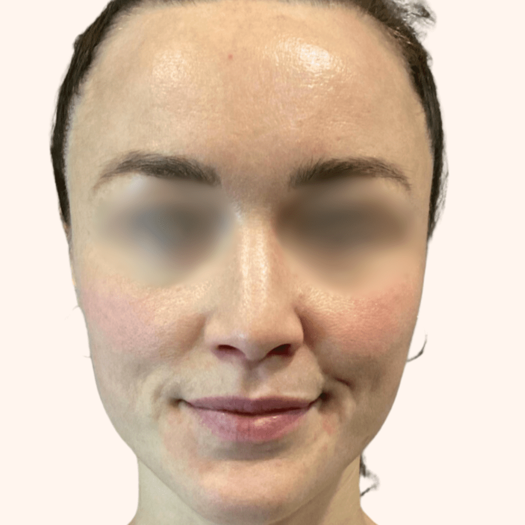 Best Sciton BBL Dublin | Laser + Skin Clinics | Dublin IPL